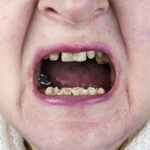 What causes of Crumbling Teeth and how it's break off?